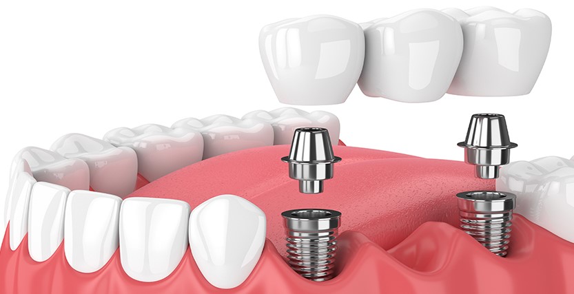 Kosten für ein Backenzahn-Implantat: Was Sie wissen sollten